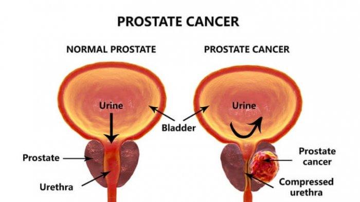 Mengenal Penyebab dan Gejala Kanker Prostat, Pria Perokok Wajib Waspada - Tribunbatam.id