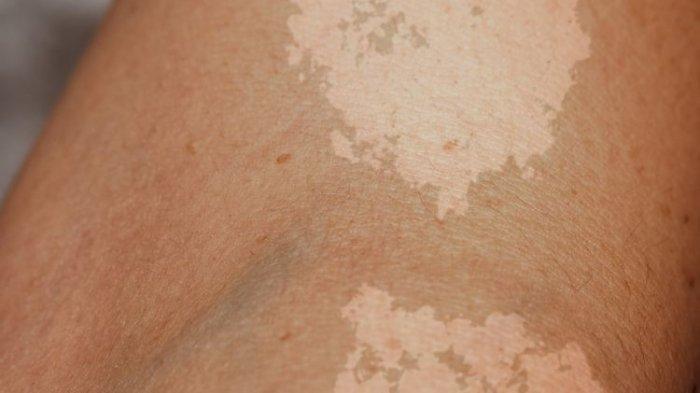 Mengenal Penyebab dan Gejala Panu, Bagaimana Cara Mengatasinya ...