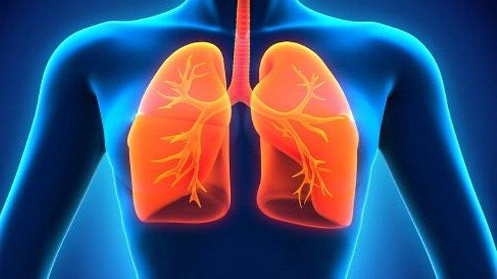 Apa Itu Infeksi Paru, Ini Gejalanya yang Bukan cuma Batuk dan Sesak ...