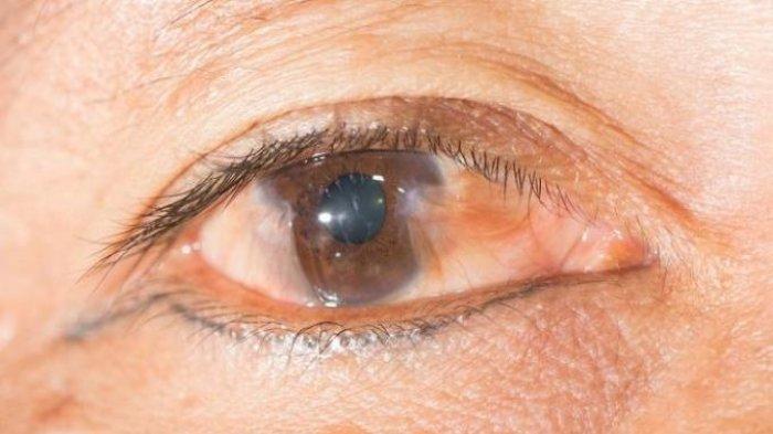 Mengenal Pinguecula, Munculnya Bintik Kuning pada Konjungtiva Mata ...