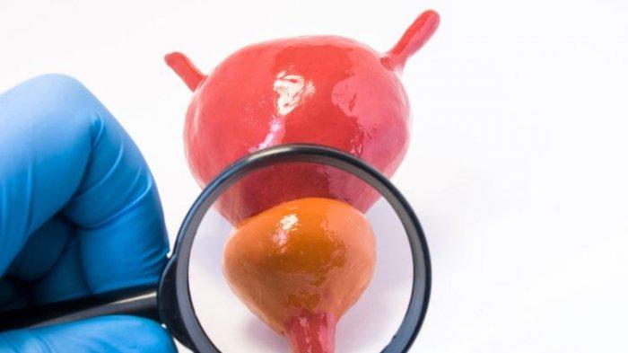 Mengenal Jenis dan Gejala Infeksi Prostat, Apa Penyebabnya ...