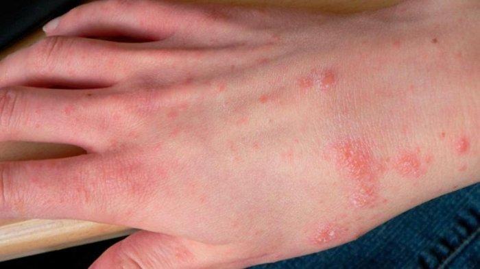 Kulit Dihuni hingga 1000 Tungau, Apa Saja Gejala dan Penyebab Scabies ...