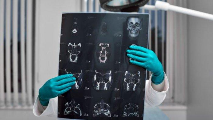 Astrositoma hingga Pineoblastoma, Inilah 15 Jenis Tumor Otak yang Perlu Diwaspadai - Tribunbatam.id