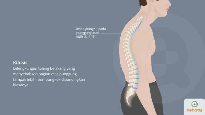 Jenis dan Gejala Kifosis, Penyakit Kelainan Tulang Belakang dari Bawaan ...