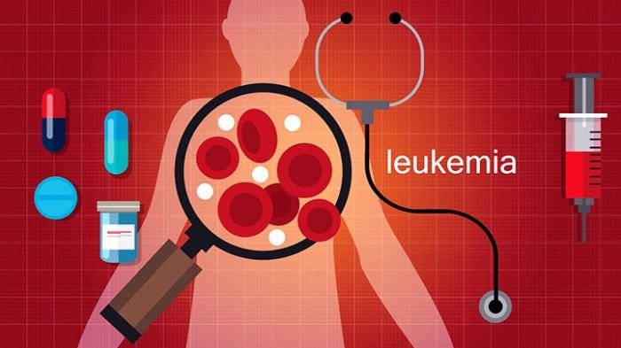 Mengenal Gejala dan Jenis Leukimia, Sering Menyerang Anak Usia Dibawah ...