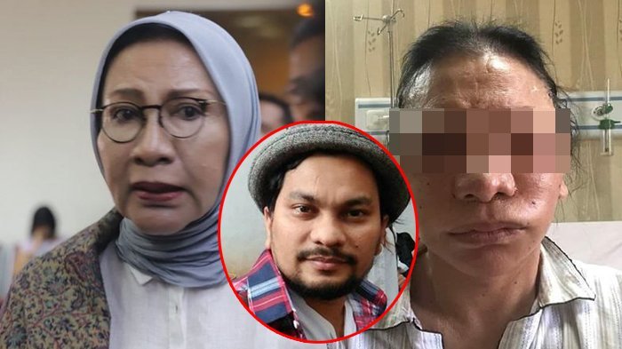 Hampir Mirip, Begini Cara Bedakan Lebam Setelah Operasi dengan Lebam ...