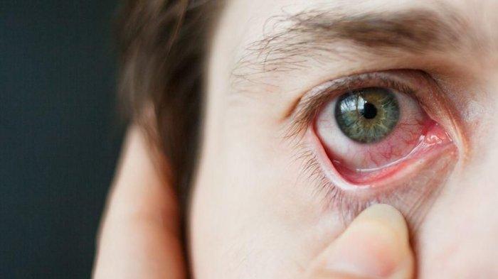 WAJIB TAHU, Inilah 9 Penyakit Mata yang Pengobatannya Ditanggung BPJS ...