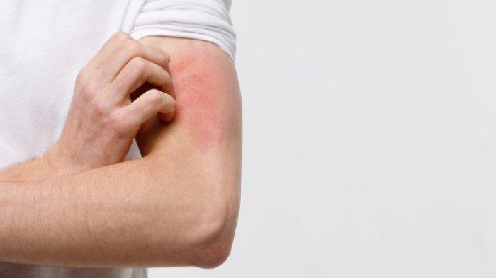 Gejala dan Ciri-ciri Scabies, 1000 Tungau Hidup di Kulit Sebabkan Rasa ...