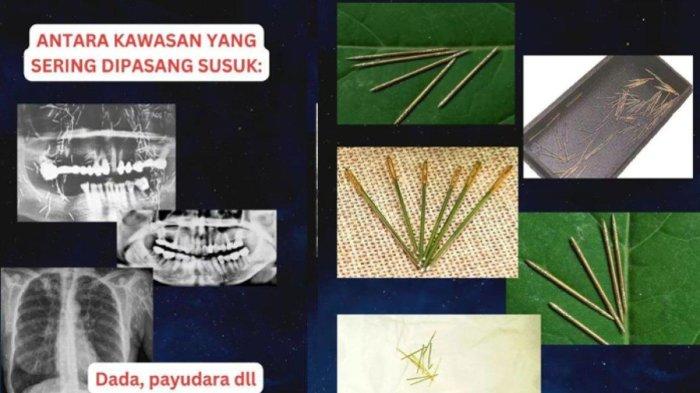 Dokter Syok Temukan Susuk di Tubuh Wanita Lumpuh, Terungkap saat X-Ray ...