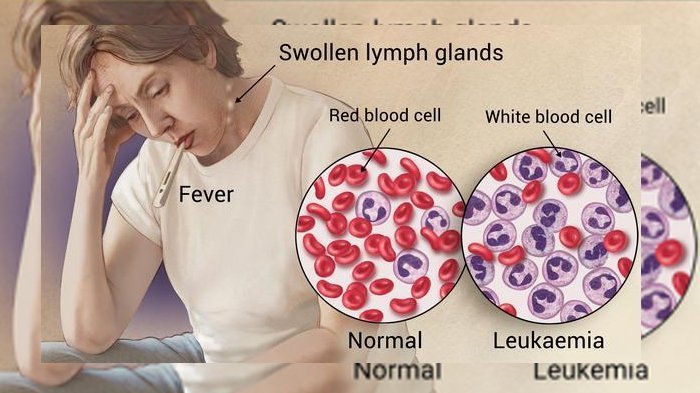 Termasuk Penyakit Ganas, Ketahui 5 Fakta Leukemia dari Gejala, Penyebab ...