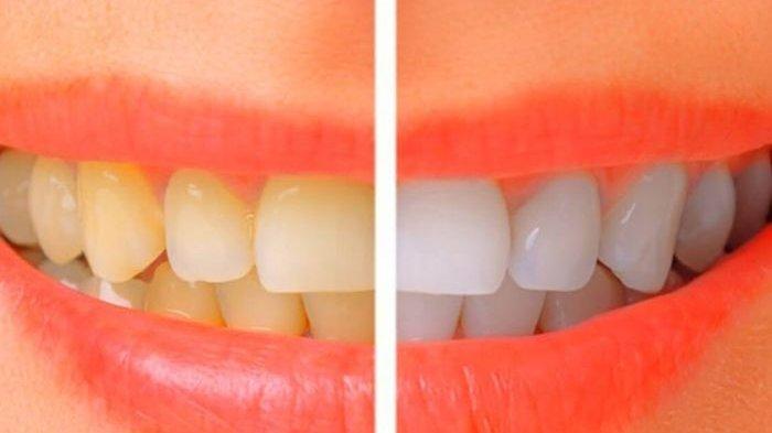 Cara Putihkan Gigi Kuning dalam 3 Menit dengan Bahan Dapur Rumahan! - Posbelitung.co