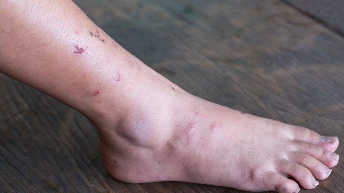 Berikut Tanda Ulkus Diabetikum, Luka di Kulit Akibat Tingginya Kadar ...