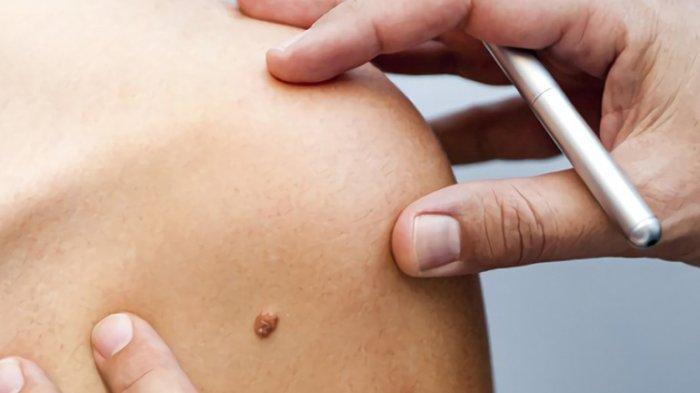 4 Cara Menghilangkan Kutil, Cukup Pakai Bahan Alami Ini, Kulit Kembali ...