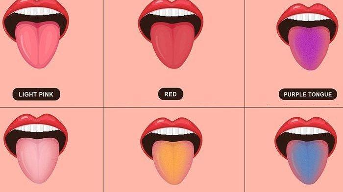 Warna dan Tekstur Lidah Bisa Gambarkan Kondisi Kesehatan dan Gejala ...
