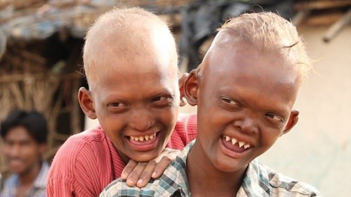 Dijuluki Anak Setan, Nasib Dua Bersaudara dari India Ini Sekarang ...