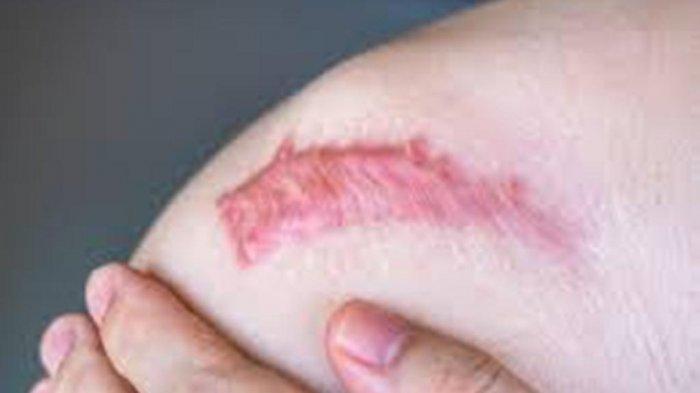 Cara Mengobati Keloid dengan Mudah dan Aman, Bisa Hilang dengan 3 Cara ...
