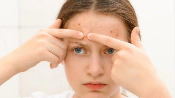 Apa Penyebab Jerawat di Dahi dan Bagaimana Mengatasinya? - Tribun Gorontalo