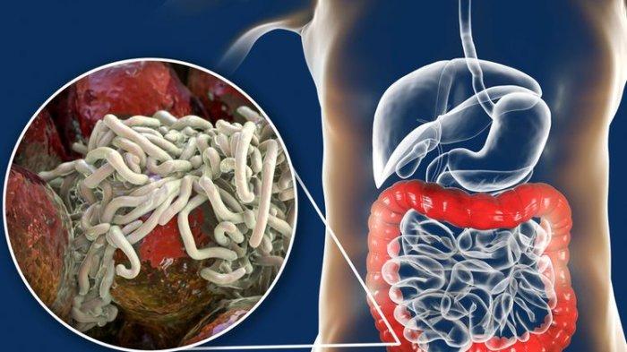 Inilah Jenis Cacing yang Paling Sering Menginfeksi Anak-anak, Simak Penuturan Dokter ...