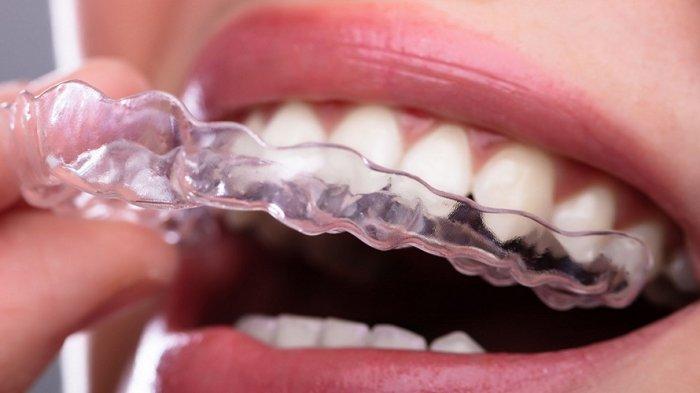 drg. Ardiansyah S. Pawinru, Sp.Ort(K) Jelaskan Jenis-jenis Retainer ...