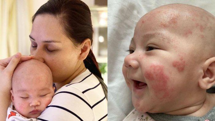 Mengenal Dermatitis Atopik, Masalah yang Timbul Akibat Peradangan Kulit ...