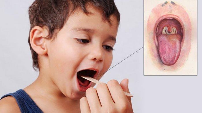 Mengenal Difteri Pada Anak, Infeksi yang Disebabkan oleh Bakteri ...