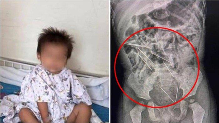 Dokter Syok Lihat Hasil Rontgen Balita Usia 2 Tahun, Ada 8 Jarum ...