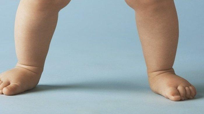 dr. Faisal Mi'raj Sebut Flat Feet Berkepanjangan pada Anak Perlu ...