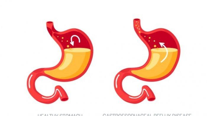 Simak Perbedaan Penyakit GERD dan Maag, Berikut Ulasan dr. Hasan Maulahela, Sp.PD.,KGEH ...