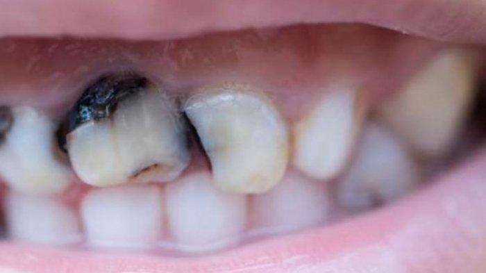 Pembuluh Darah dan Saraf yang Mati Mempengaruhi Perubahan Warna pada ...