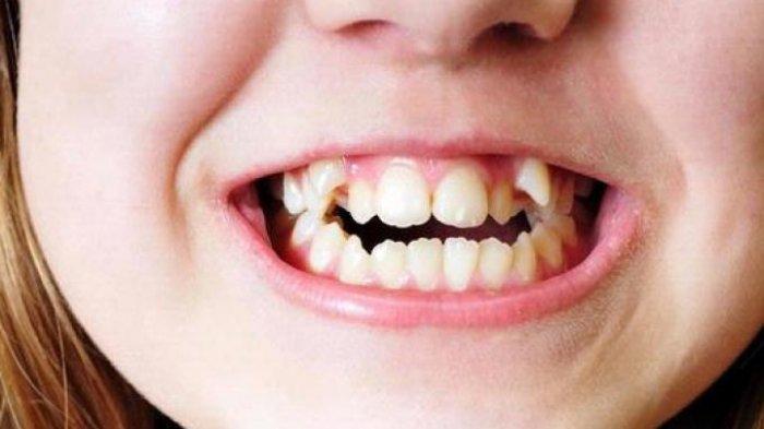 Apakah Gigi Tidak Rapi Bisa Masuk TNI? Berikut Penjelasan Dokter ...