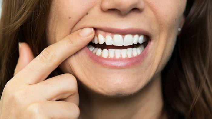 Gusi Turun Bisa Disebabkan Banyak Hal, Mulai Penyakit Periodontal ...