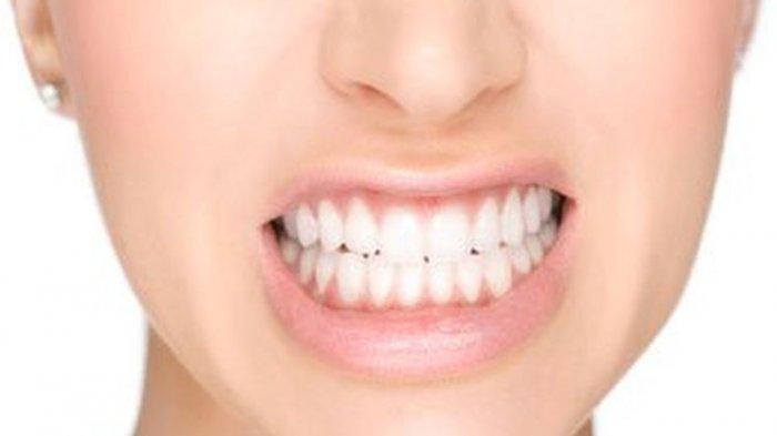 Perlu Tahu, Ini Kriteria Gusi yang Sehat menurut drg. R. Ngt. Anastasia ...