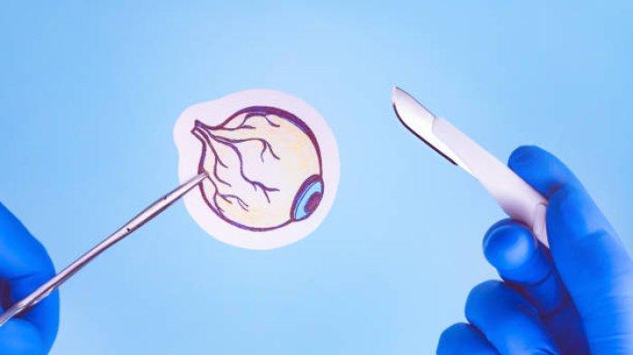 Bisakah Melakukan Cangkok Mata jika Mengalami Kebutaan? Begini Kata ...