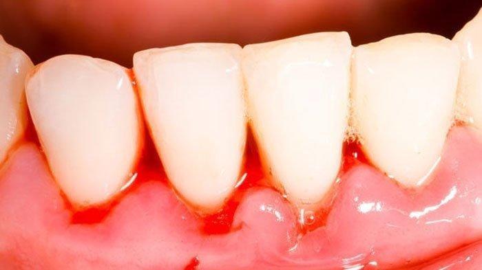 Kenali Gejala Gingivitis atau Radang Gusi Agar Tidak Terjangkit, Simak ...