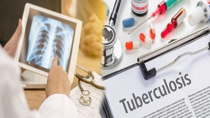 Dokter, Apa Perbedaan TBC pada Anak dan Orang Dewasa? Ini Jawaban dr ...