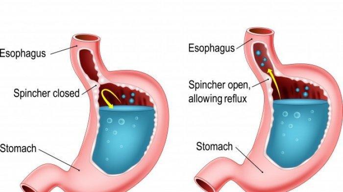 Mengenal Penyakit Lambung Kronis (GERD) dan Cara Mecegahnya ...