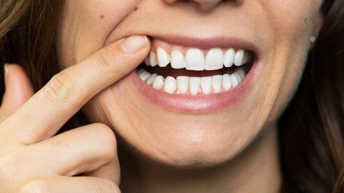 Apa Penyebab Gusi Turun? Ini Tanggapan Dr. drg. Munawir H. Usman, SKG ...