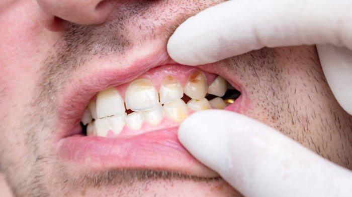 Mengenal Kategori Keausan Gigi Salah Satunya Erosi Gigi yang Dipaparkan ...