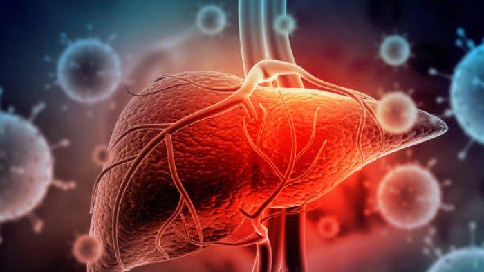 Inilah Gejala Penyakit Liver, Dokter Spesialis Penyakit Dalam Sebut ...