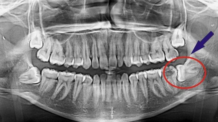 Kenali Asal Muasal Terjadinya Gigi Impaksi dari Dr. drg. Munawir H ...