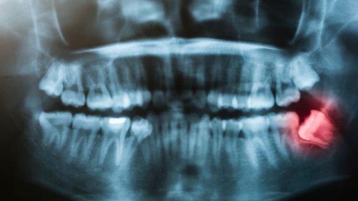 Dr. drg. Munawir H. Usman, SKG., MAP: Deteksi Dini Gigi Impaksi Bisa ...