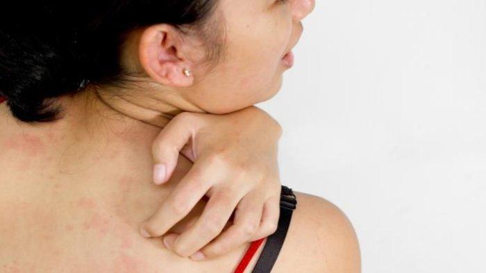 Infeksi Jamur Ternyata bisa Terjadi Karena Kontak Langsung, Berikut ...