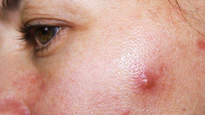 Pesan dr. Nila Purnama Sari Perihal Atasi Kulit Berjerawat: Matikan ...