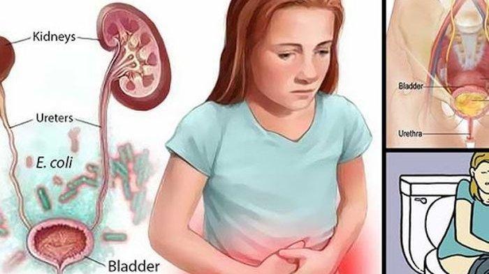 Penyebab Infeksi Saluran Kandung Kemih yang Harus Diwaspadai, Berikut Penjelasan Dokter ...