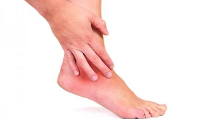 Rangkaian Pemeriksaan dalam Deteksi Varises, Dokter: Curigai Benjolan ...