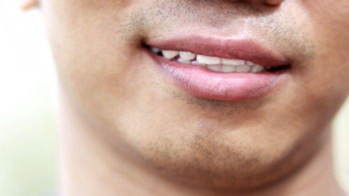 Kenali Beberapa Gejala Kanker Mulut yang Disampaikan oleh drg. Andi ...