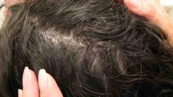 Benar atau Tidak, Jarang Kramas Memicu Munculnya Kutu Rambut? Berikut ...