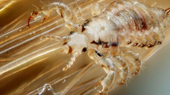 Ketahui Ciri Khas untuk Menentukan Seseorang Mengalami Masalah Kutu ...