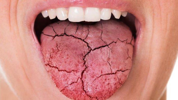 Bakteri Jadi Pemicu Terbanyak Infeksi Rongga Mulut, Ini Penjelasan drg ...