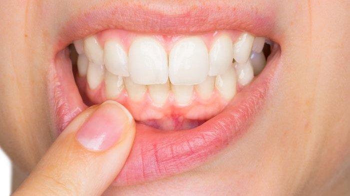 Waspada, Infeksi Gigi dan Jaringan Penyangga Gigi Terjadi Akibat ...